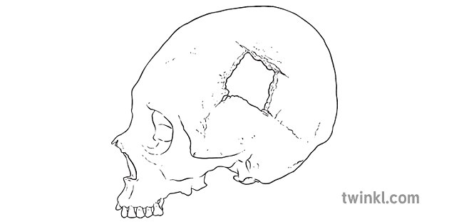 inca cerebro cirugía cráneo trepanación inca ks2 blanco y negro ...