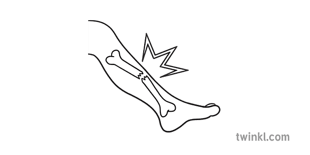 SYM Broken Leg BW Illustration