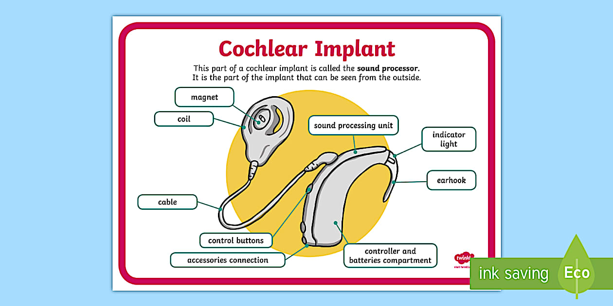Editable Cochlear Implant Sound Processor Display Poster