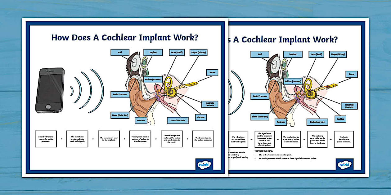 How Does a Cochlear Implant Work? Poster - Twinkl