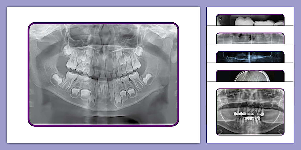 Teeth X-ray Photo Pack - Twinkl - KS1
