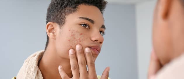 Parents give advice on helping teenagers with problem skin - Twinkl Digest